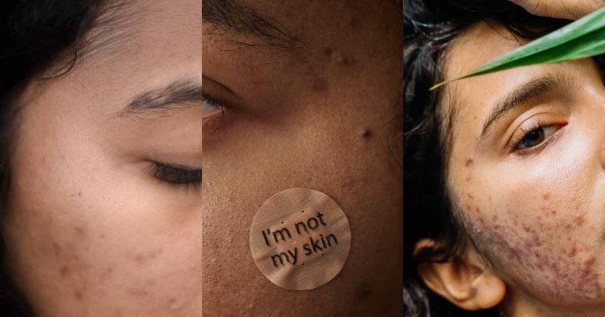 Skincare Ingredients To Avoid If You Have Sensitive Skin