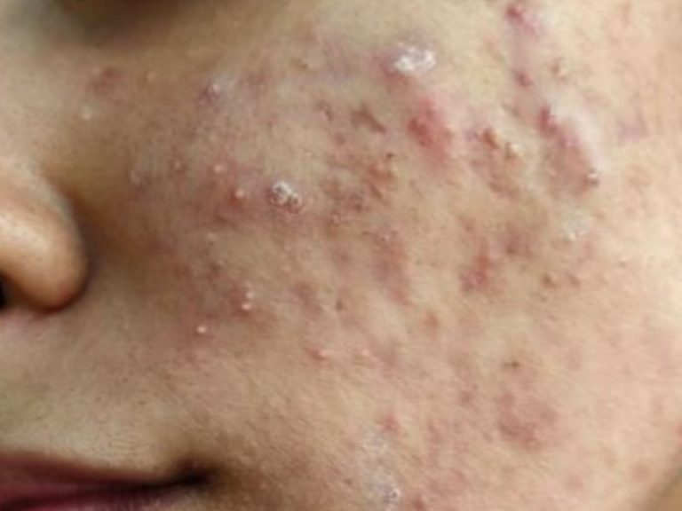 5 Jenis Jerawat Di Muka Dan Cara Merawatnya Dengan Berkesan