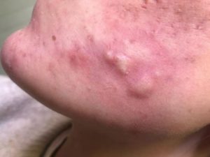 5 Jenis Jerawat Di Muka Dan Cara Merawatnya Dengan Berkesan