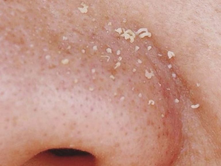 5 Jenis Jerawat Di Muka Dan Cara Merawatnya Dengan Berkesan